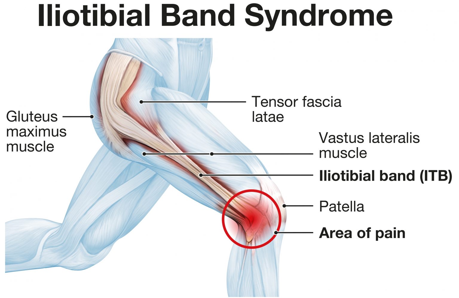 Iliotibial Band Pain (ITBS) Explained — Expert Treatment in Buxton ...