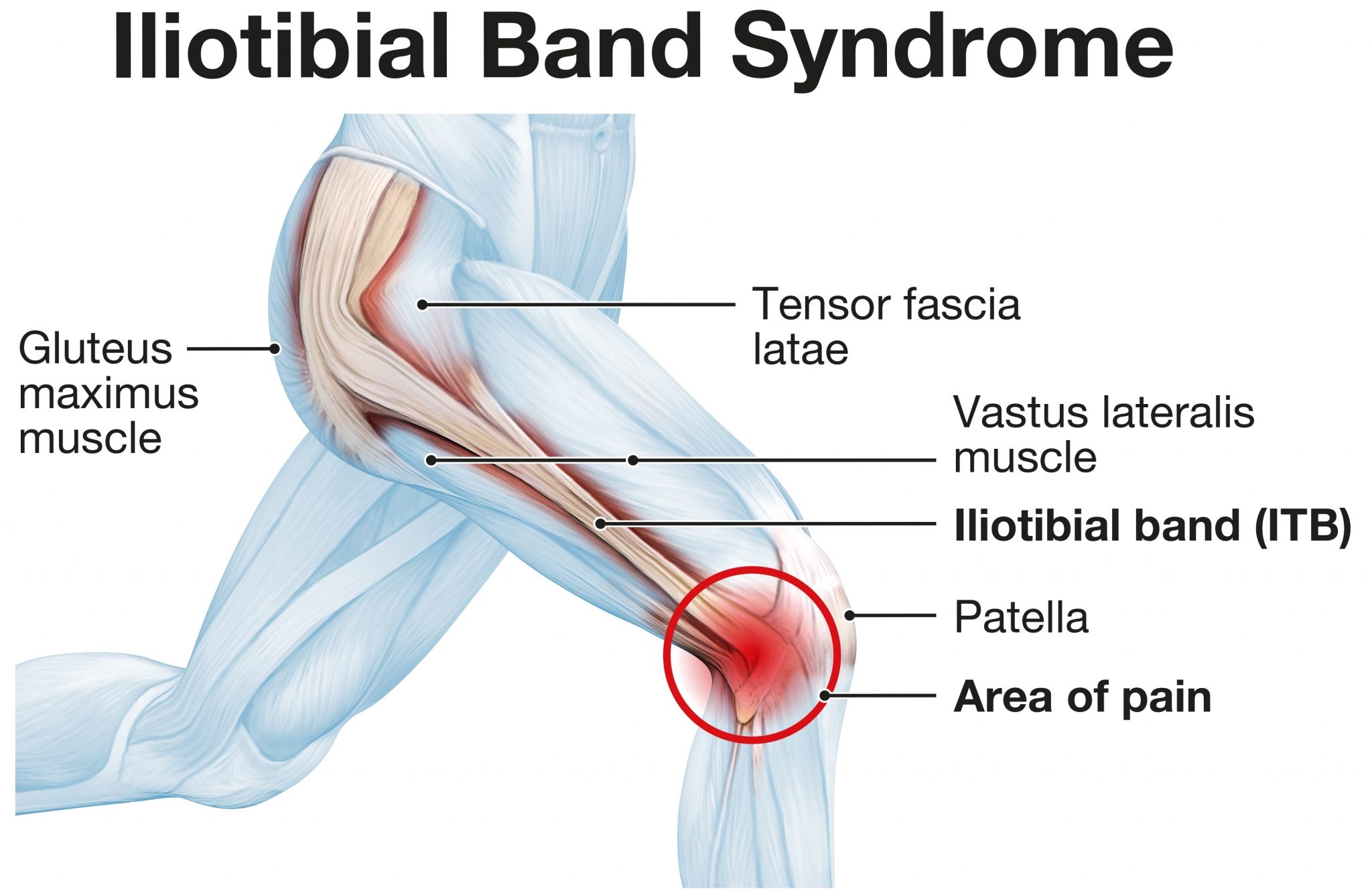 Iliotibial Band Pain (ITBS) Explained — Expert Treatment in Buxton ...
