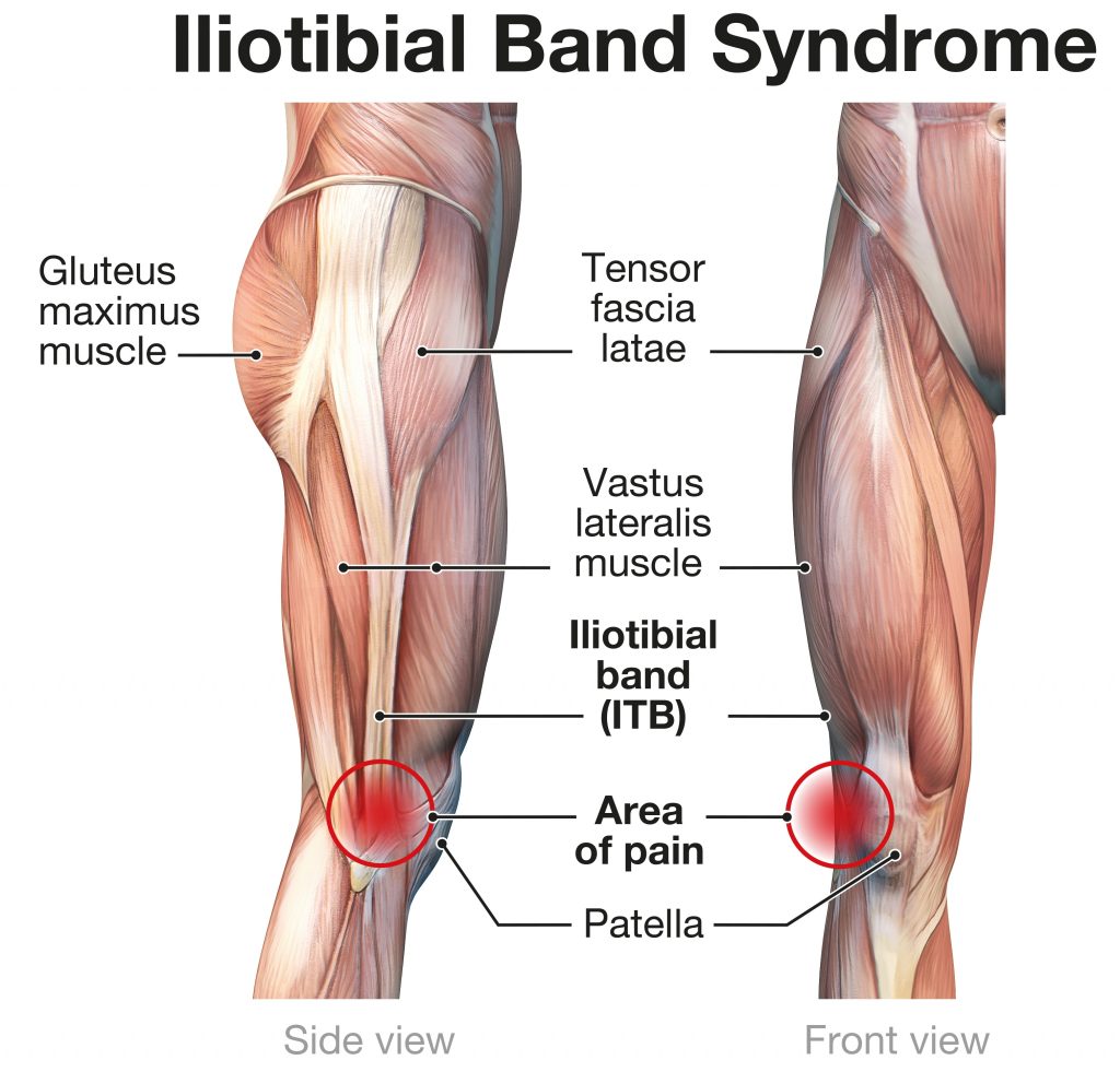 Iliotibial Band Pain (ITBS) Explained — Expert Treatment in Buxton ...
