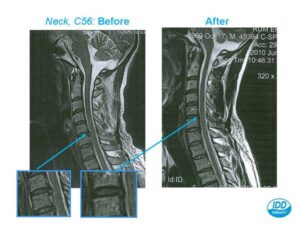 IDD Therapy Disc Treatment: How it Works - Buxton Osteopathy